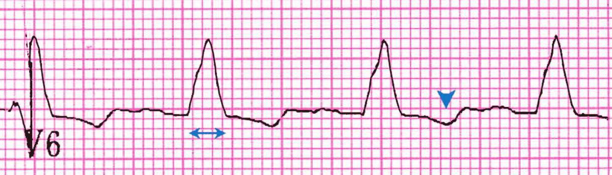 Study Medical Photos: Left Bundle Branch Block - ECG