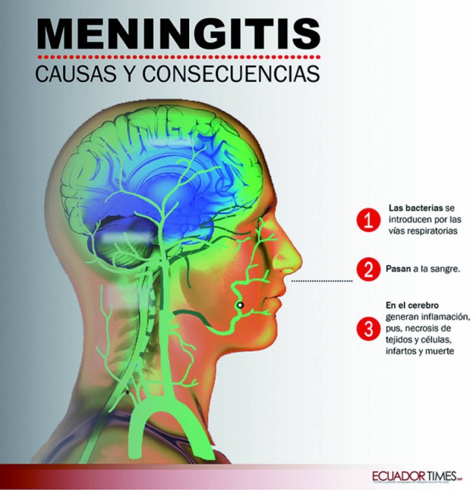 Meningitis aguda | Diagnostico Medico