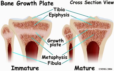 Treating Achondroplasia: March 2015