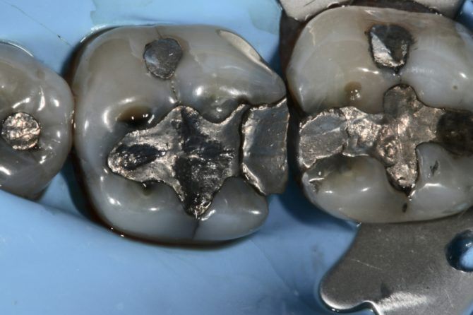 AMALGAMA DENTAL: ¿Estamos preparados para su erradicación?