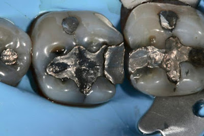 AMALGAMA DENTAL: ¿Estamos preparados para su erradicación?