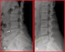 Radiologia para Técnicos: VÉRTEBRA EM LIMBO
