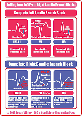 ECG Educator Blog : Bundle Branch Blocks
