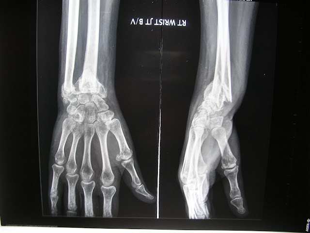 X-rays and Slides: malunion of distal radius-ulna fracture with ...
