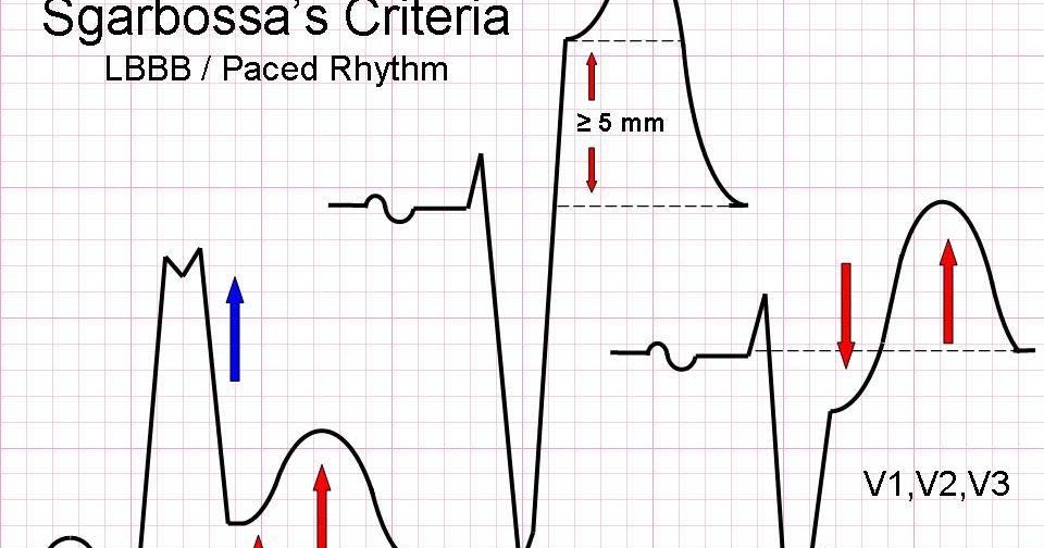 Sgarbossa Criteria Untuk Diagnosis AMI pada LBBB | INA - ECG