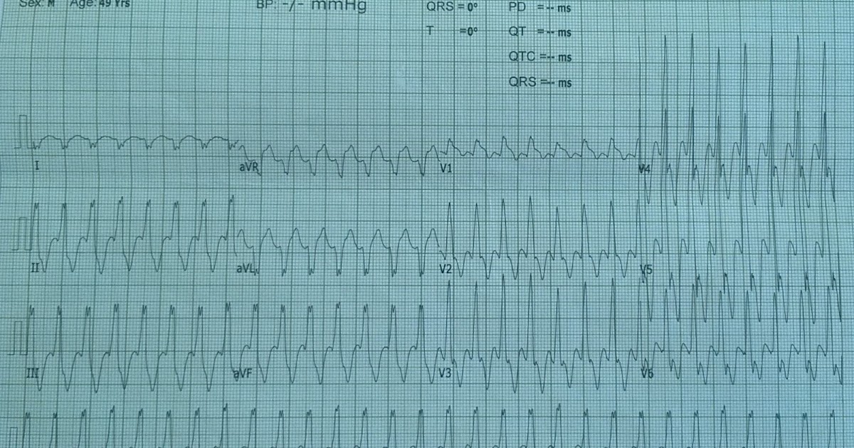 Cardiology window: ECG SVT with aberrancy
