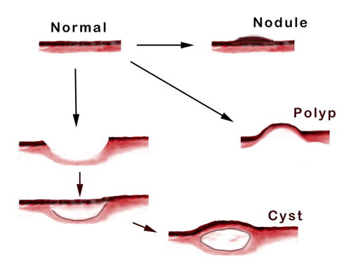 How Do Vocal Cord Cysts Polyps And Nodules Form Fauquier Ent Blog