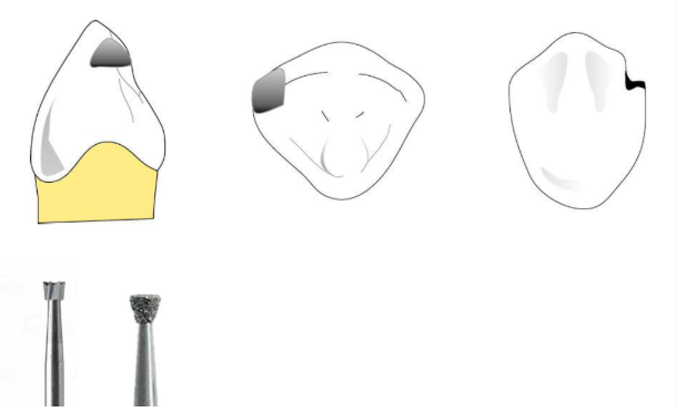 Prótesis Parcial Removible (PPR)