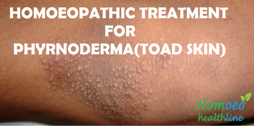 PHRYNODERMA ( TOAD SKIN) & HOMOEOPATHIC TREATMENT