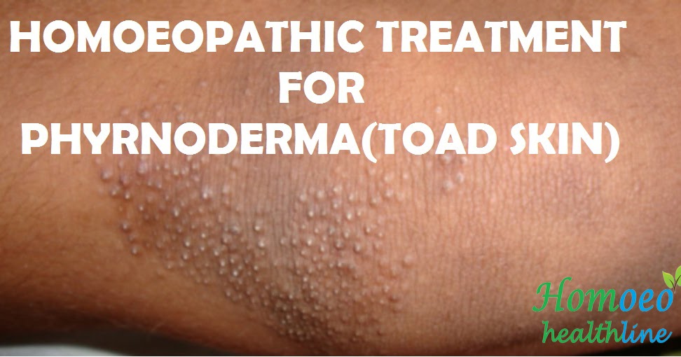 PHRYNODERMA ( TOAD SKIN) & HOMOEOPATHIC TREATMENT