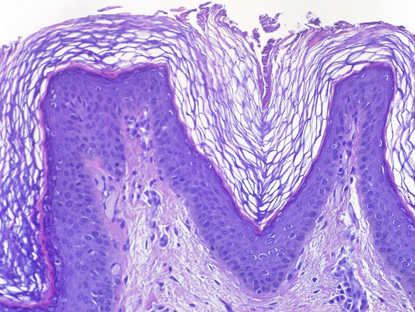 Confluent And Reticulated Papillomatosis Pathology