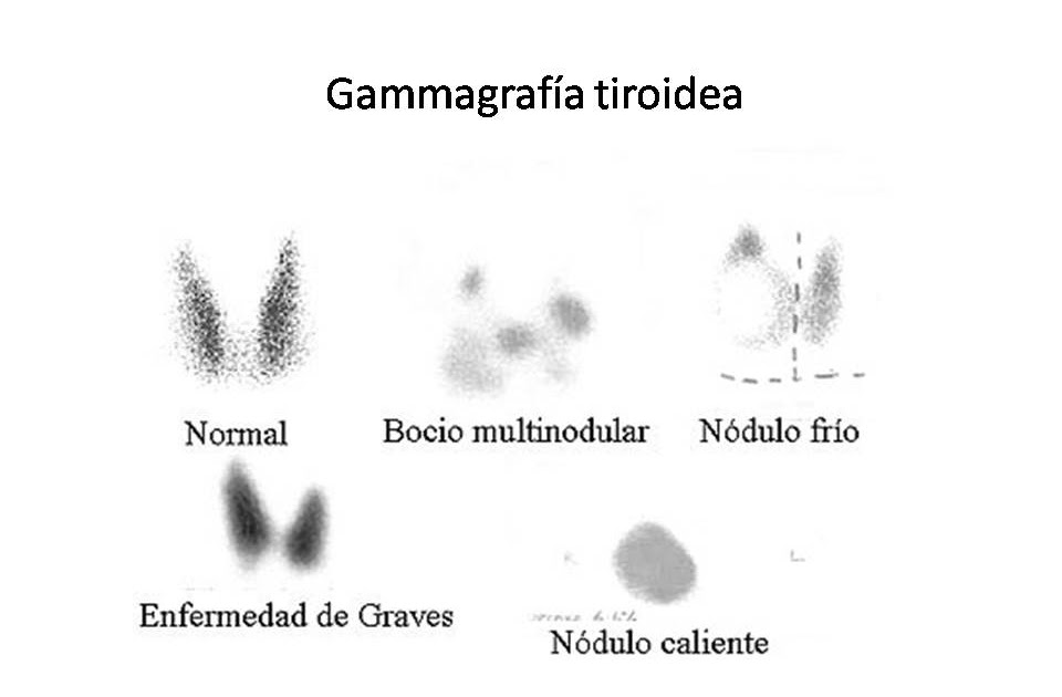 Exploraciones complementarias del tiroides | El blog de Ricardo Ruiz de ...