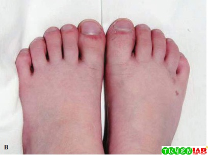 [Pediatric] Atlas of Clubbing and cyanosis | Free Medical Atlas