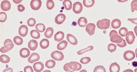 Medical Laboratory and Biomedical Science: Iron-Deficiency Anemia in ...