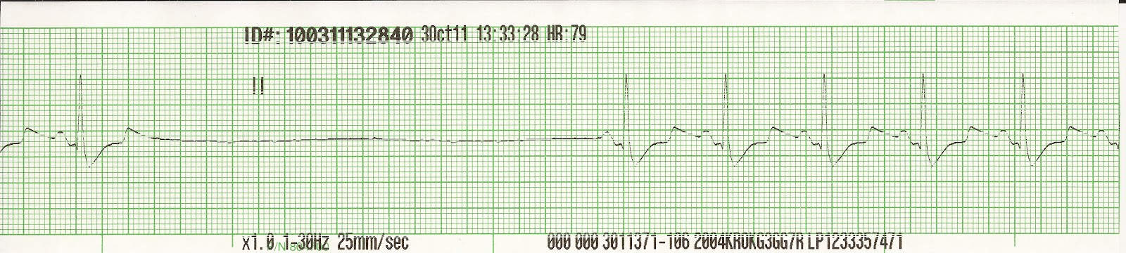 EKG Rhythm Strips 15: Sinus Rhythms
