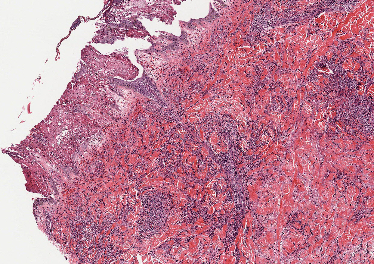 Differential Diagnosis in Dermatopathology: Pink staining