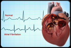 Sistem Peredaran Darah: Embolisme Koroner, Fibrilasi Atrium, Varises ...