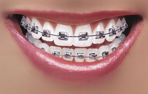 DENTAL: Dental Braces - A Great Choice for a Perfect Smile