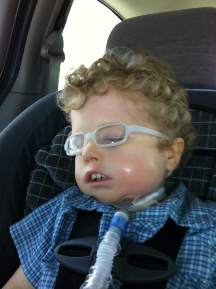 Moebius Syndrome and Our Family: Surgery, what surgery... oh wait yeah ...