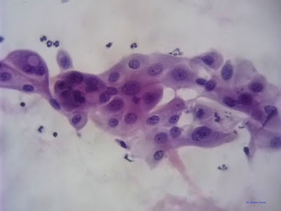 THE PERUVIAN CYTOPATHOLOGY CORNER: CITOLOGÍA CERVICAL: ADENOCARCINOMA ...