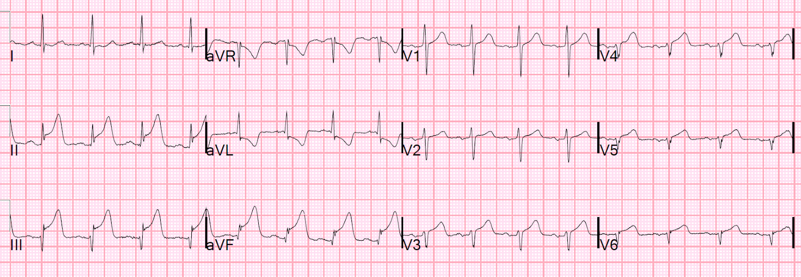 Dr. Smith's ECG Blog: Inferolateral STEMI: is there right ventricular ...