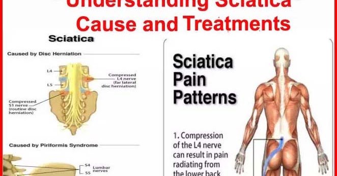 Practical Sciatica Relief Information: Understanding Sciatica - Cause and Treatments