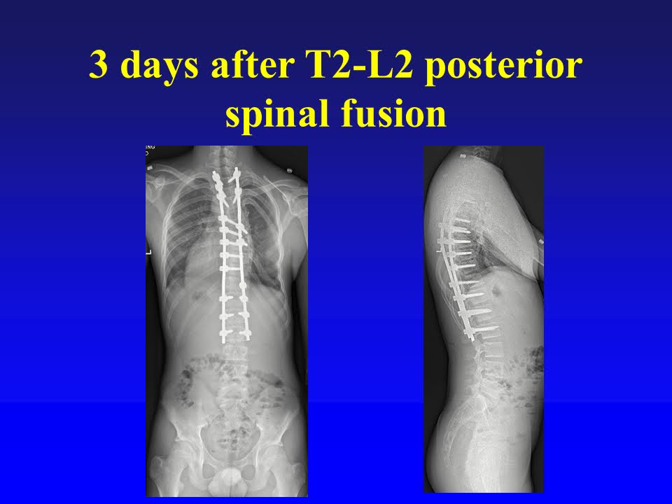 Sports after Posterior Spinal Fusion T2-L2, 1 year postoperative ...