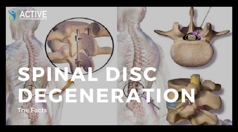 Chiropractic & Laser Therapy: Spinal Disc Degeneration: The Facts