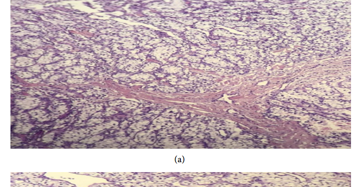 Cutaneous Metastasis of Renal Cell Carcinoma: A Case Report