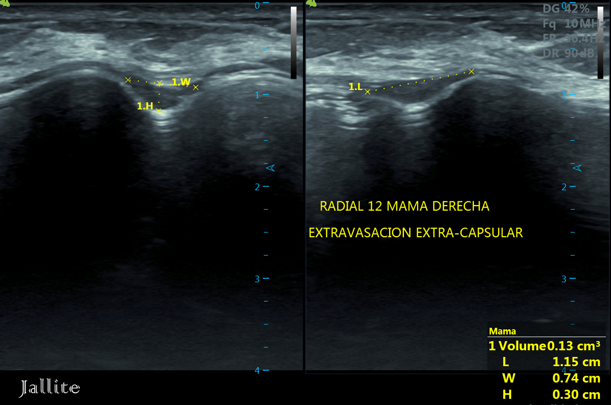 Roturas & Infiltraciones Implantes Mamarios