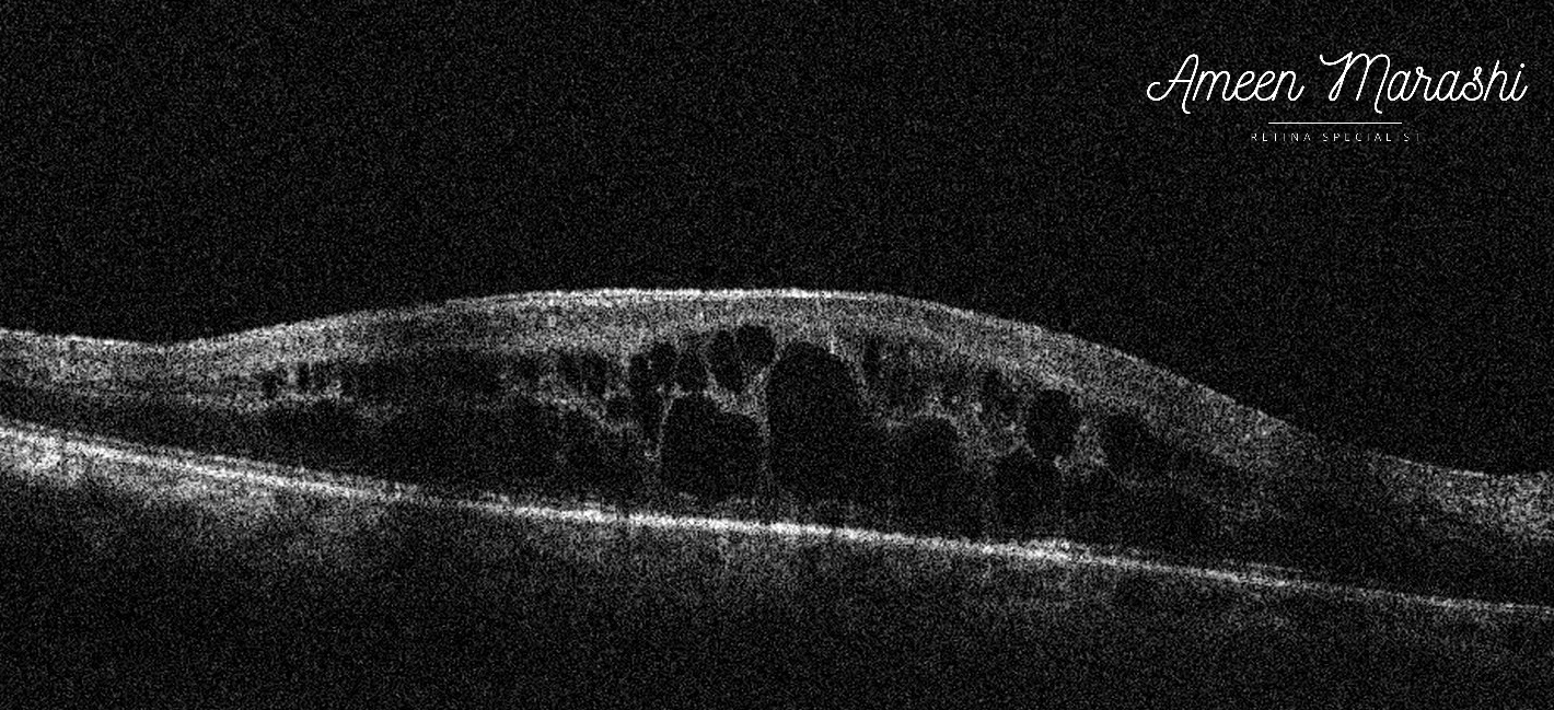 How would you approach this case of intraocular inflammation in a ...