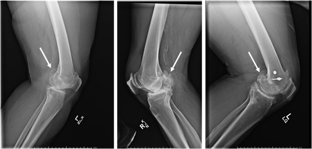 Revisiones_bibliográficas TyO_Web: ¿Cuál es el efecto de los osteofitos ...