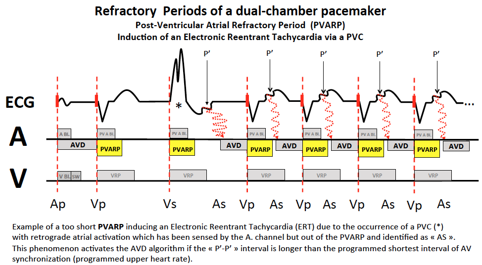 Dr Han Naung @ Henry Han : Electrophysiology and Heart Rhythm : AV ...