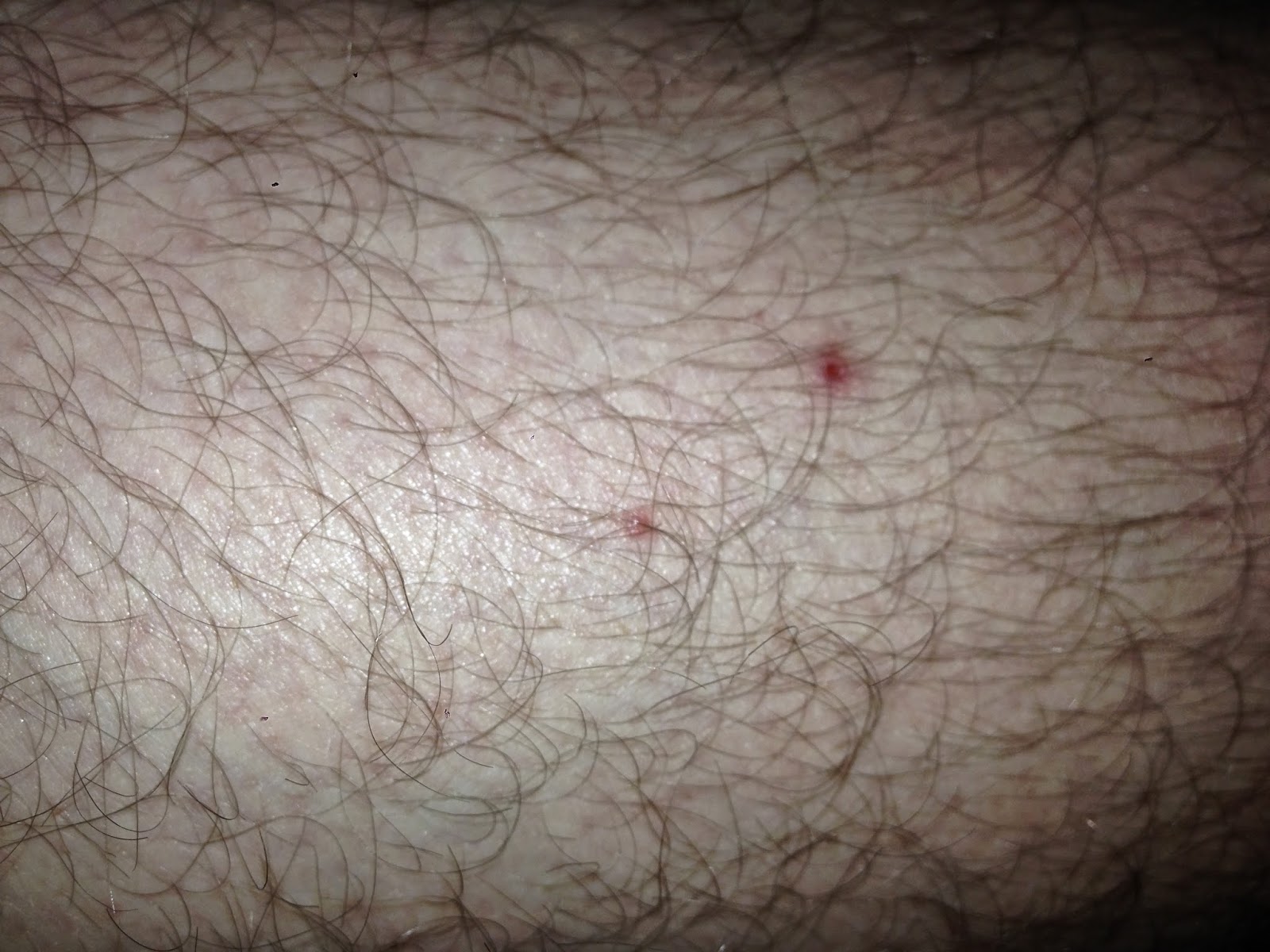 Scabies Treatment That Truly Works (My Personal Experience)