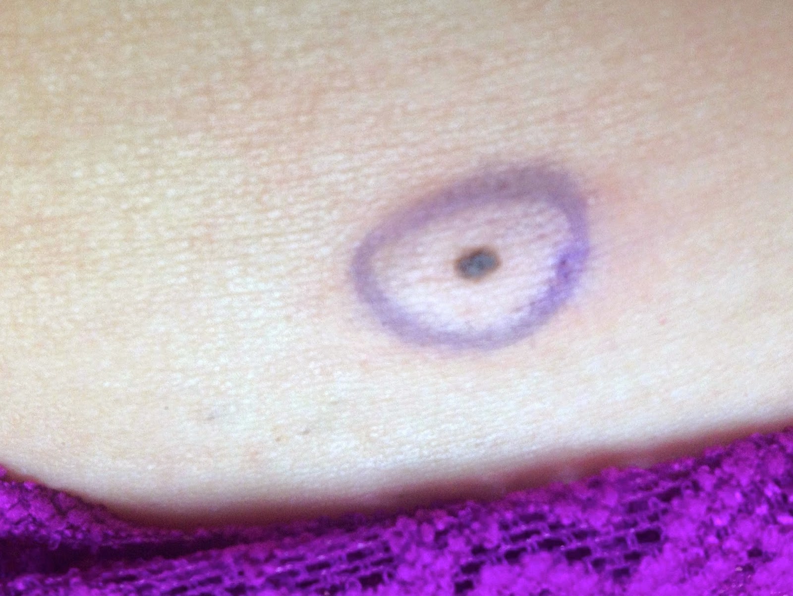 Precancerous Mole Now What ~ Germain Dermatology Patient Specials
