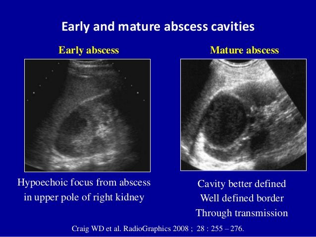 MEDICAL ULTRASOUND/ABSCESS IN KIDNEY