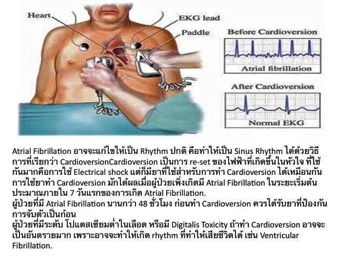 Atrial Fibrillation and Cardioversion