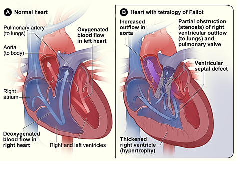 His Rare Case of CHD : Tetralogy of Fallot (ToF) with PA and MAPCAs ...