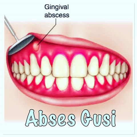 Tips dan Informasi Tentang Kesehatan: Atasi Abses Gusi Pada Anak
