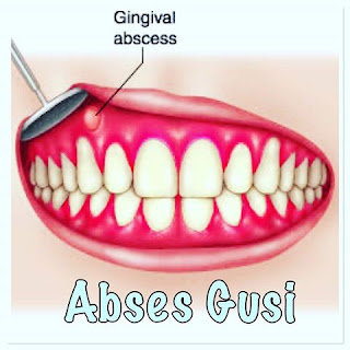Tips dan Informasi Tentang Kesehatan: Atasi Abses Gusi Pada Anak