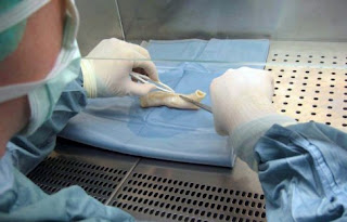 Primer trasplante de tráquea impresa en 3D