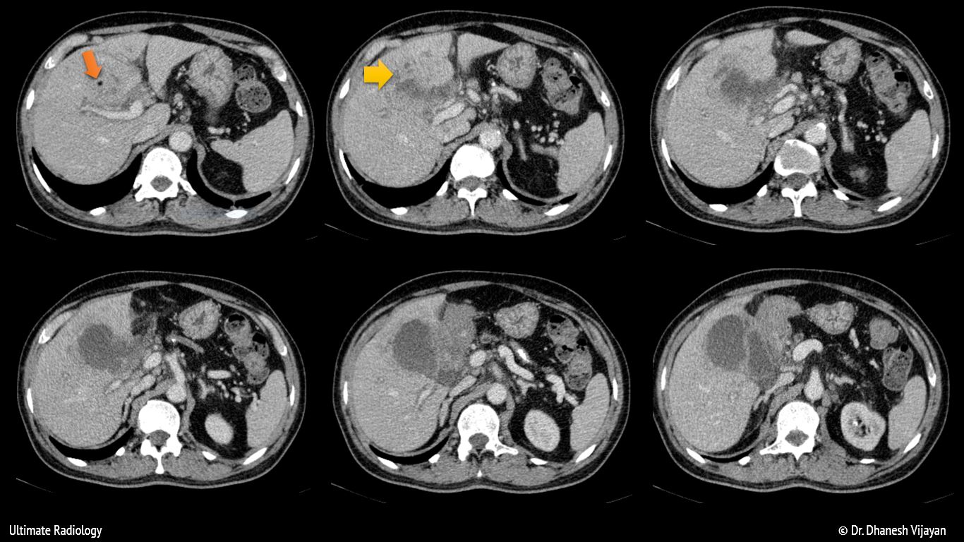 Ultimate Radiology : Acute Cholecystitis with intrahepatic perforation ...