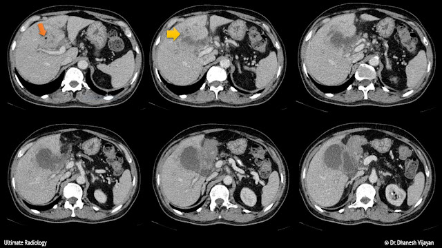 Ultimate Radiology : Acute Cholecystitis with intrahepatic perforation ...