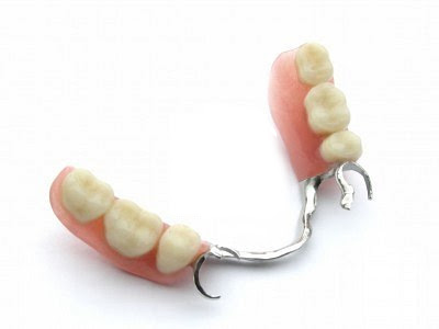 Dentosphere : World of Dentistry: MCQs on Removable Partial Dentures ...