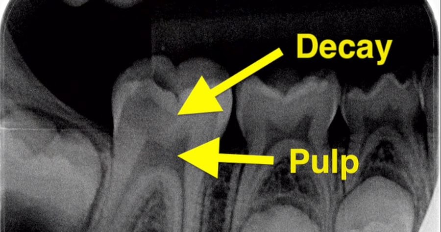 ENDODONTICS: Deep Tooth Cavity - Healed Tooth without a Root Canal ...