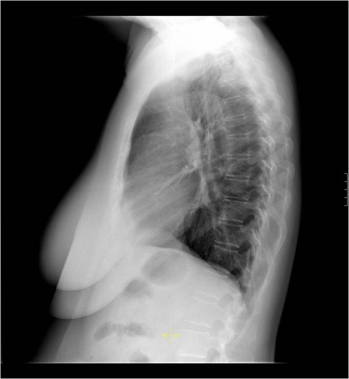 ¿Sabemos leer una RX de tórax? Parte 1: Recuerdo anatómico ...