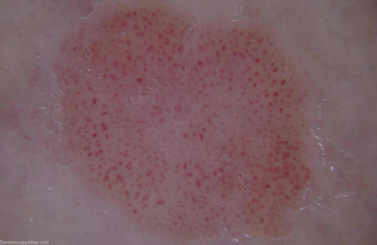 Dermoscopy Features as Clues: Dots Red