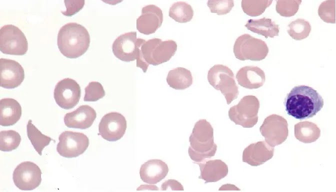 Microangiopathic hemolytic anemia (MAHA)