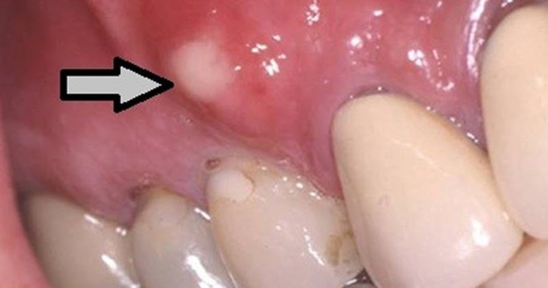 Abscessed Tooth - Symptoms, Causes & Treatment
