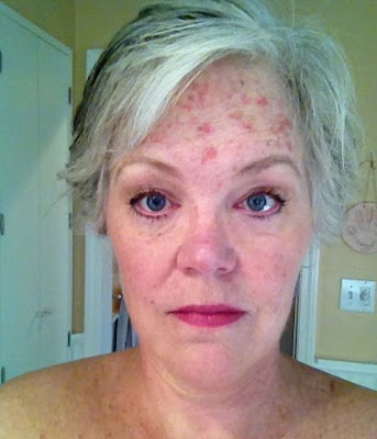 Boomer Girl Diary: Efudex Day 10